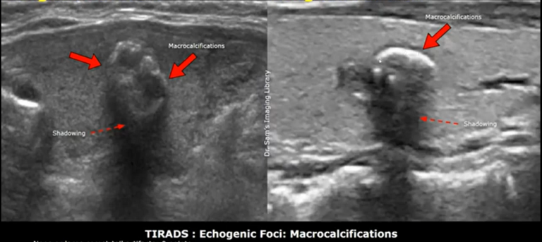 Early Stage Thyroid Cancer Ultrasound Images - Tirads Calculator