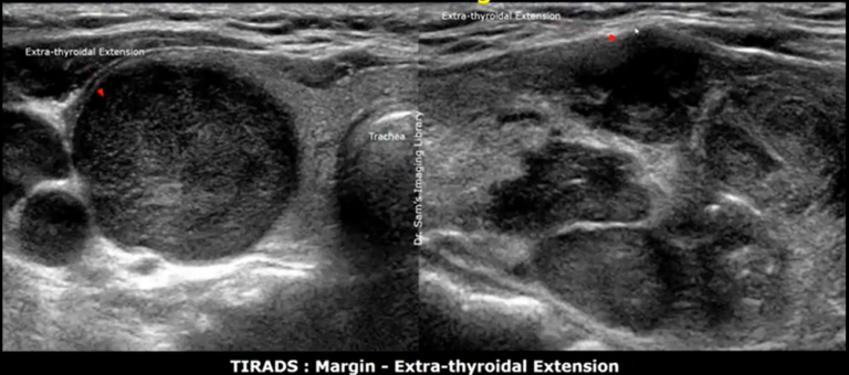Tirads Calculator - Tirads Calculator