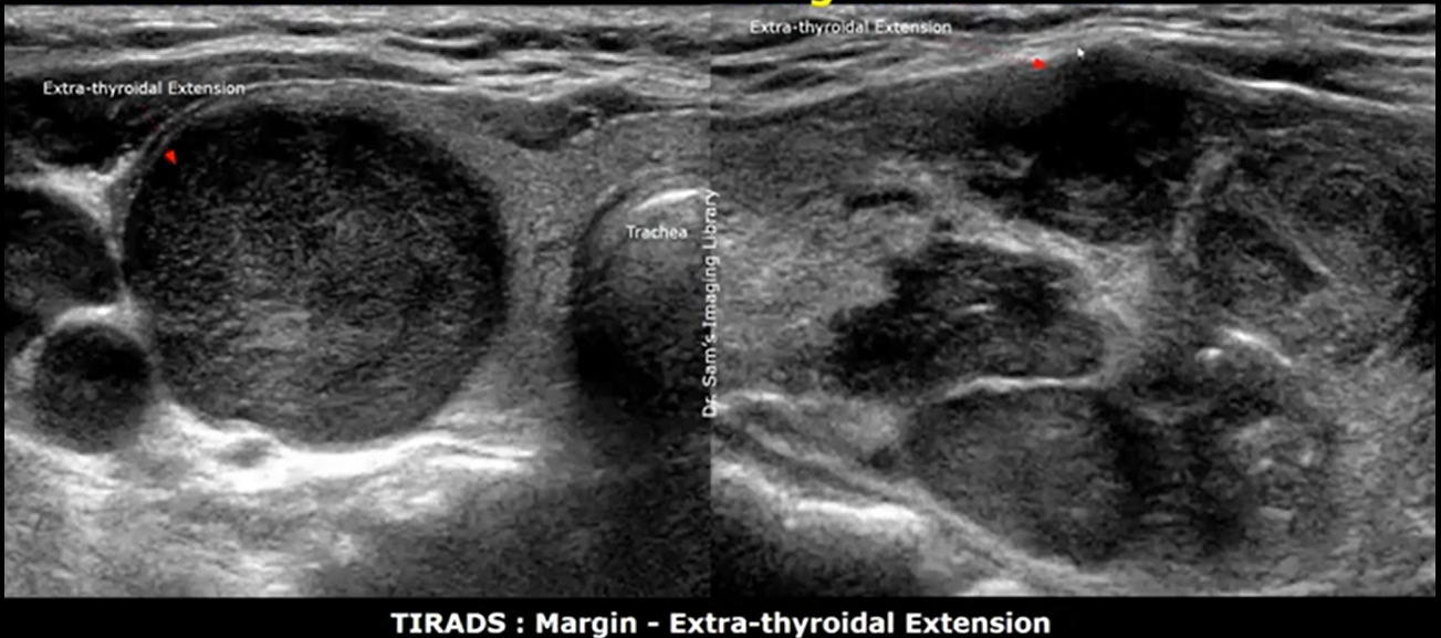 Tirads Calculator - Tirads Calculator