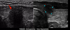 Tirads Calculator - Tirads Calculator