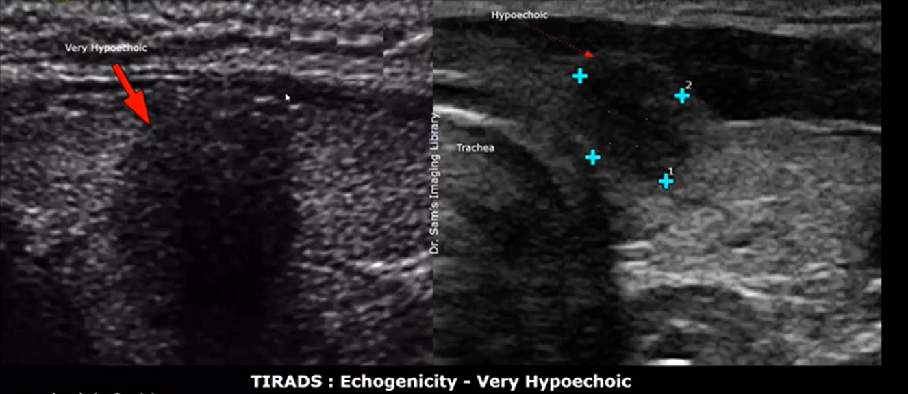 Tirads Calculator - Tirads Calculator