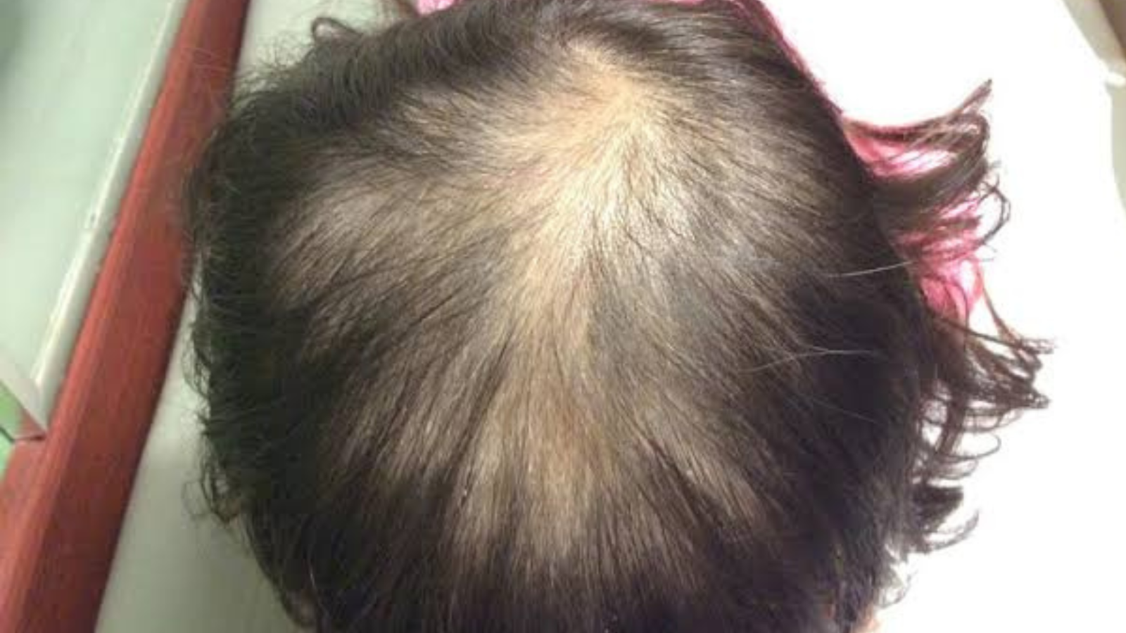 How to Stop Hair Fall Due to Thyroid: A Step-by-Step Guide - Tirads ...