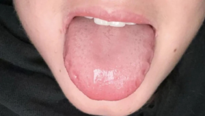 Thyroid Scalloped Tongue: Causes, Treatment, and Remedies - Tirads ...